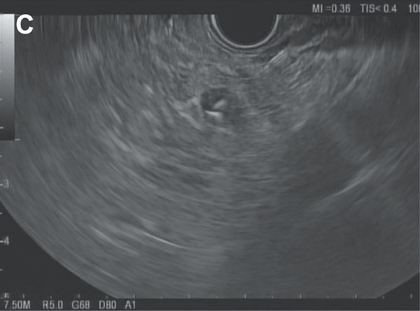 Pancreatic Cystic Lesions: A Case-Based Approach