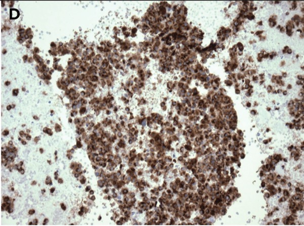 Pancreatic Cystic Lesions: A Case-Based Approach