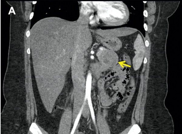 Pancreatic Cystic Lesions: A Case-Based Approach