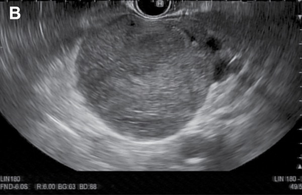 Pancreatic Cystic Lesions: A Case-Based Approach