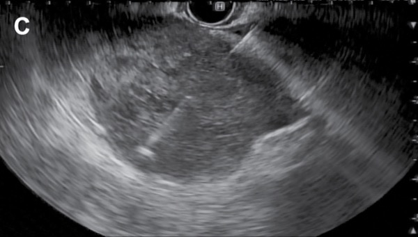 Pancreatic Cystic Lesions: A Case-Based Approach