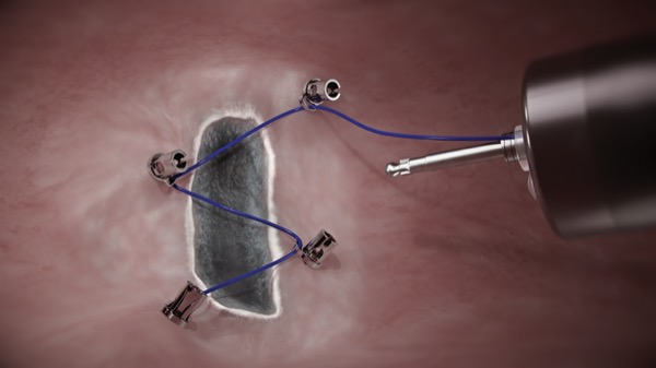 Through-the-Scope Suturing Achieves Full Closure of Large EMR Defects