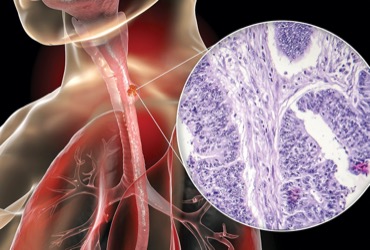 T1b Resection Esophageal Cancer Endoscopic