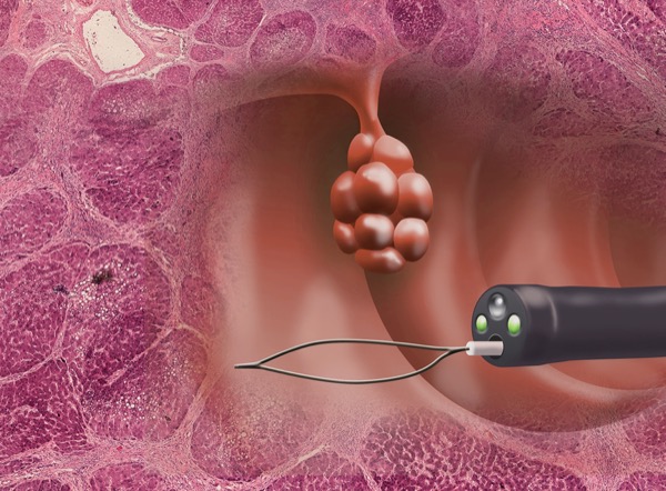 Advanced Endoscopy Not Off-Limits in Cirrhosis - Gastroenterology ...