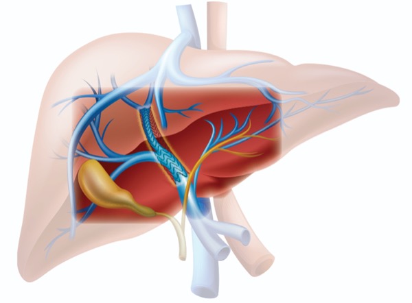 Tranjugular Intraheptic Portosystemic Shunt TIPS Inflammation