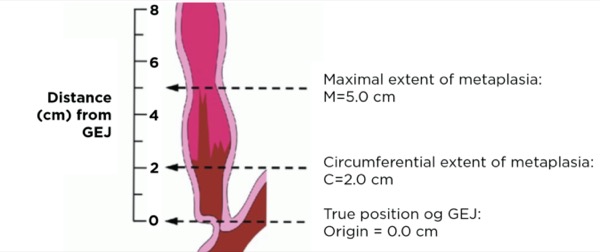 Endoscopy for Barrett’s Esophagus