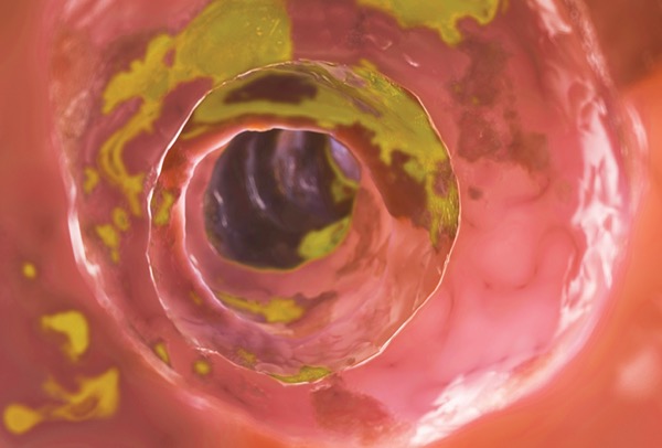 Treatment of C. difficile Infection