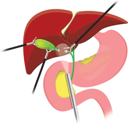 Rates of Cholecystectomy for Gallbladder Pancreatitis Low ...