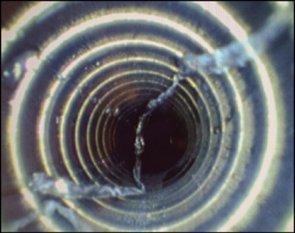 Fluid Retention, Channel Shredding Common in GI Scopes