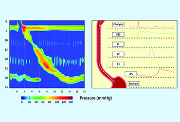 Upper Esophageal Sphincter Manometry