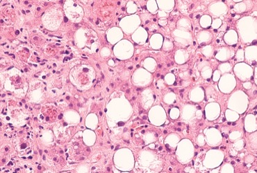 Fatty Liver Histology