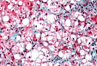 NAFLD Nonalcoholic Steatohepatitis Nonalcoholic Fatty Liver Disease ...