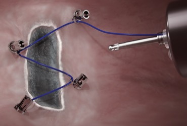 Through-the-Scope Suturing Achieves Full Closure of Large EMR Defects