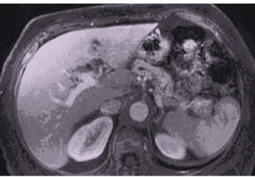 magnetic resonance elastography liver disease diagnosis