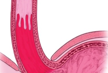 Endoscopy for Barrett’s Esophagus