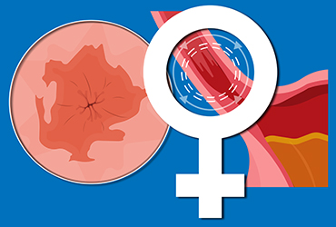 Barrett's Esophagus on the Rise Among Females
