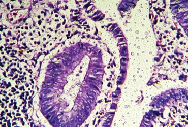 After Positive Stool Test, Colonoscopy Should Look Closely for Serrated ...