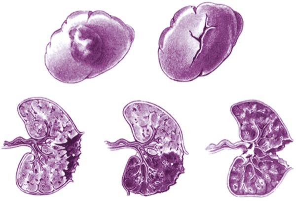 Splenic Injury in Colonoscopy