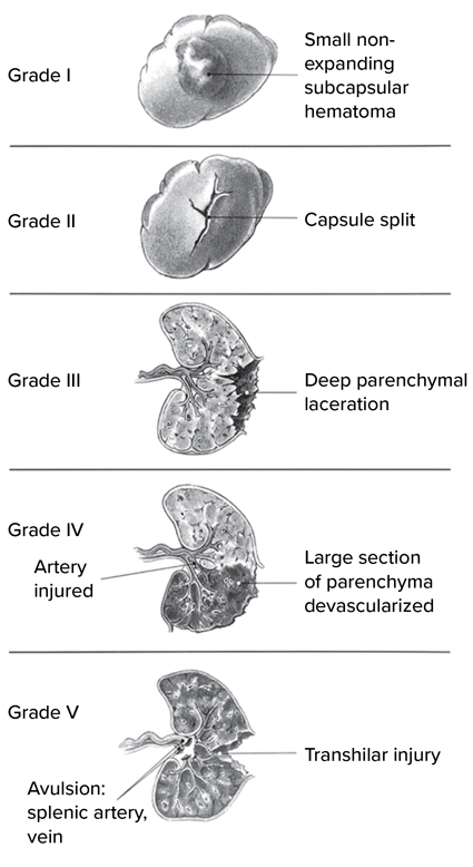 Splenic Injury in Colonoscopy