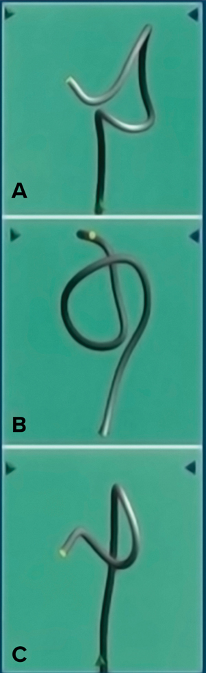 Splenic Injury in Colonoscopy