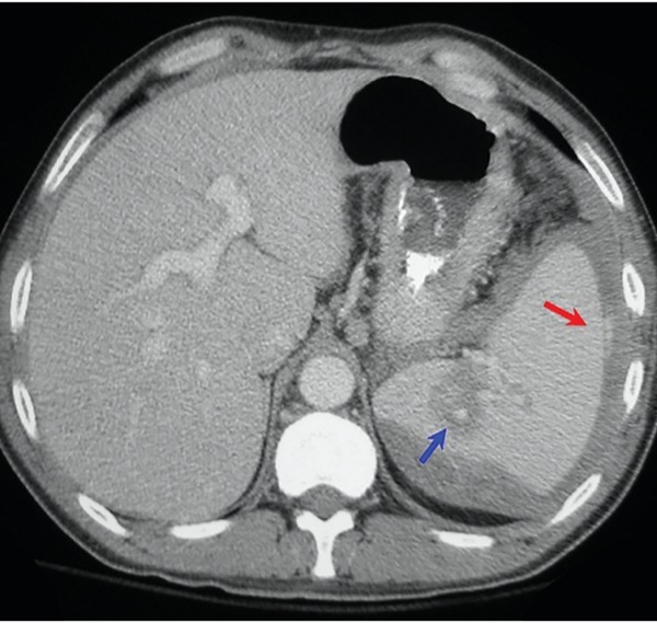Splenic Injury in Colonoscopy