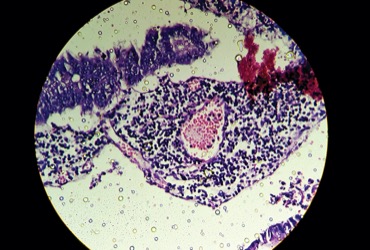 Sessile Serrated Polyps finding management