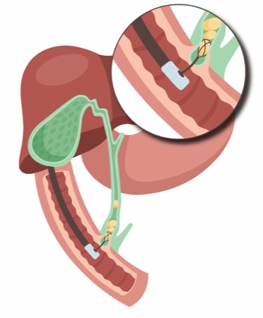 Sharma's Endoscopy Insights CRC Colonoscopy Achlasia ERCP EUS