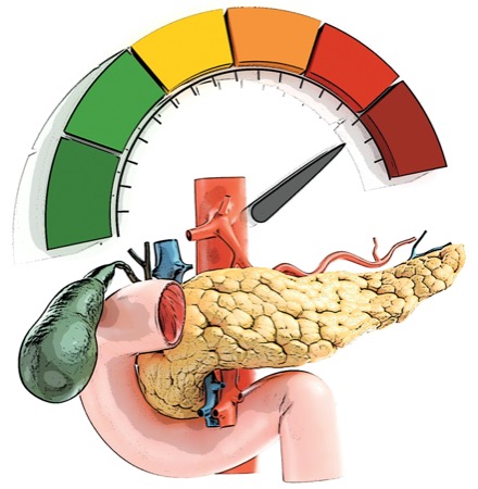 After Acute Pancreatitis, Pancreatic Disease Worsens for One in Four ...