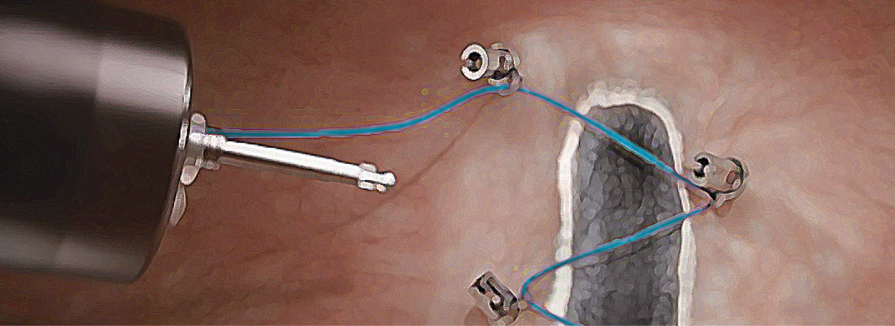 Endoscopic Resection in UC, TTS Suturing, Esophageal Cryotherapy
