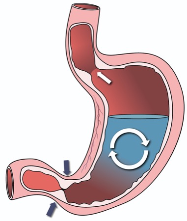 G-POEM Improves Quality of Life in Patients With Gastroparesis for ...