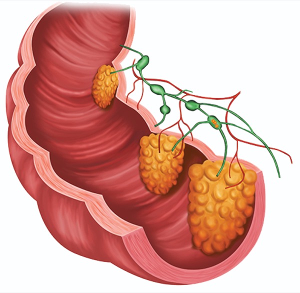 Polyp Measurement, H. pylori and Gastric Cancer, and Large ...