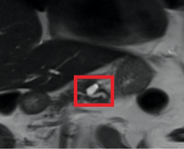 Pancreatic Cystic Lesions: A Case-Based Approach