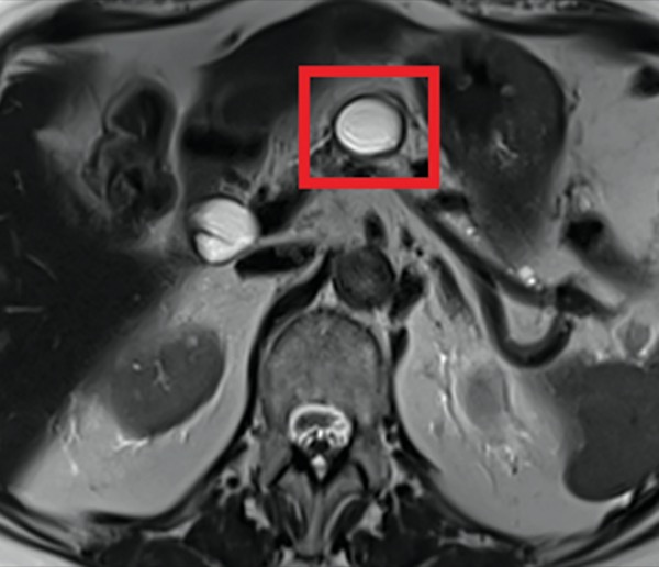 Pancreatic Cystic Lesions: A Case-Based Approach