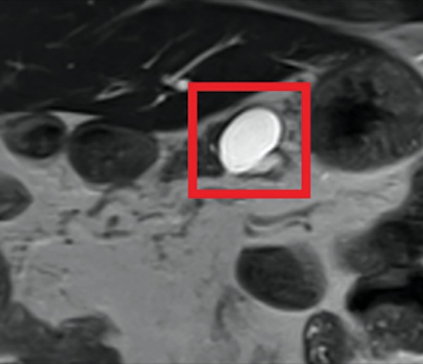 Pancreatic Cystic Lesions: A Case-Based Approach