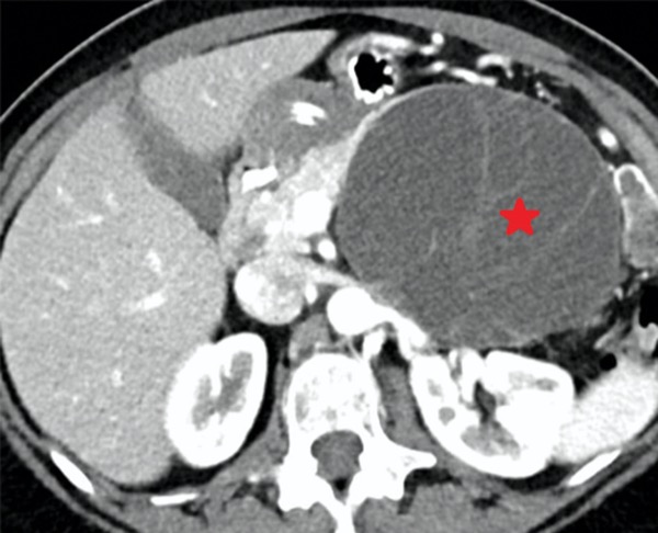 Pancreatic Cystic Lesions: A Case-Based Approach