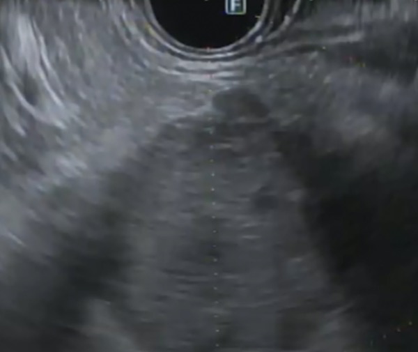 Pancreatic Cystic Lesions: A Case-Based Approach