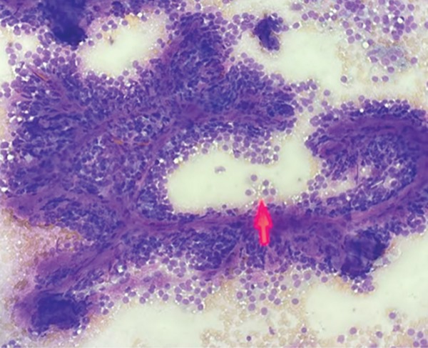 Pancreatic Cystic Lesions: A Case-Based Approach