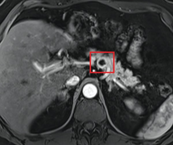 Pancreatic Cystic Lesions: A Case-Based Approach