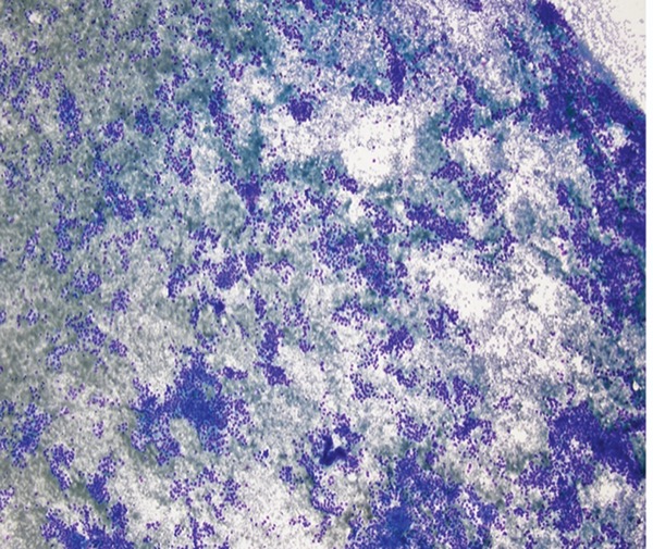 Pancreatic Cystic Lesions: A Case-Based Approach