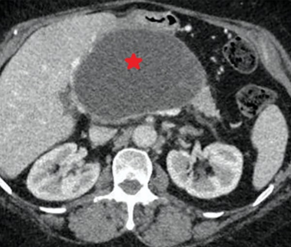 Pancreatic Cystic Lesions: A Case-Based Approach