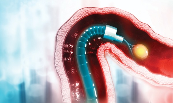 New ASGE Guideline on ESD in the Setting of Early Esophageal and ...