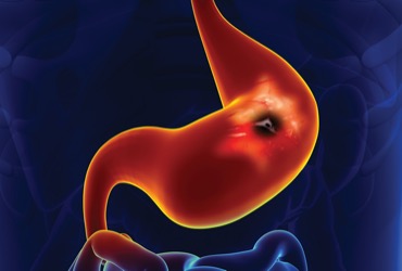 peptic ulcers endoscopy