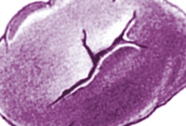 FDA Approves New Drinkable Bowel Prep Option With Suflave