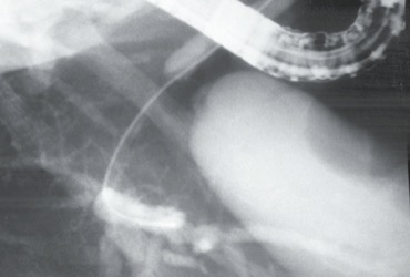 ERCP monitored anesthesia