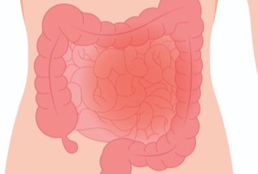 crohn's disease strictures pathophysiology starting biologics early