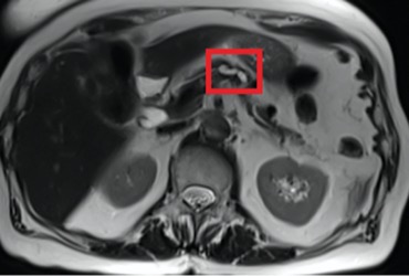 Pancreatic Cystic Lesions: A Case-Based Approach
