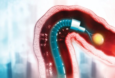 ASGE guideline endoscopic submucosal dissection early esophageal ...