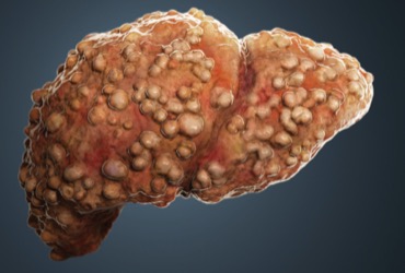 ACG guideline acute liver failure