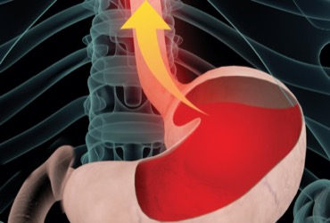 nonerosive gastroesophageal reflux disease acid reflux cancer risk