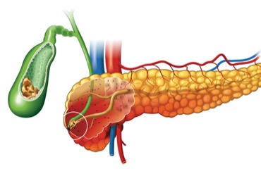 Perianal Abscess, Pancreatitis, and More From the Surgical Infection ...